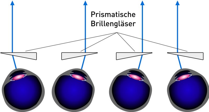 Winkelfehlsichtigkeit: Das steckt dahinter | Brille24 DE
