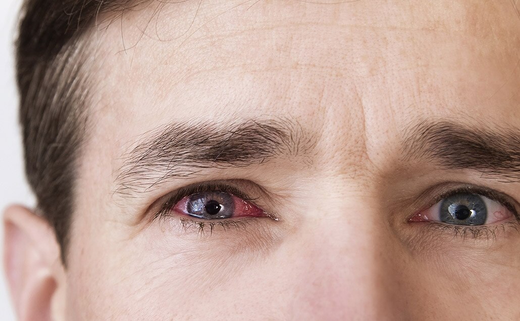 Habe ich Augenherpes? | Brille24 DE