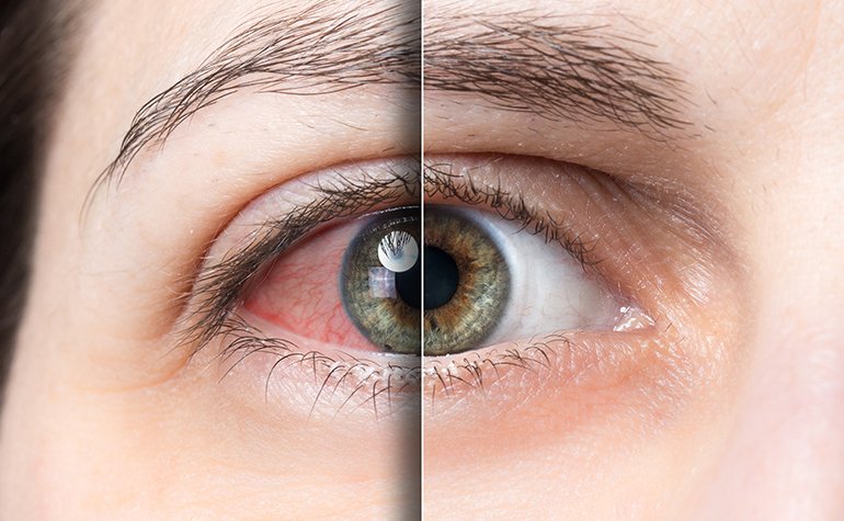 Rote Augen: Ursachen und Behandlungsmöglichkeiten | Brille24 DE