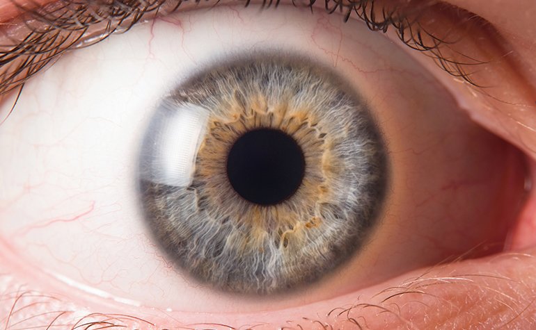 Endokrine Orbitopathie: Hervortretende Augen | Brille24 DE