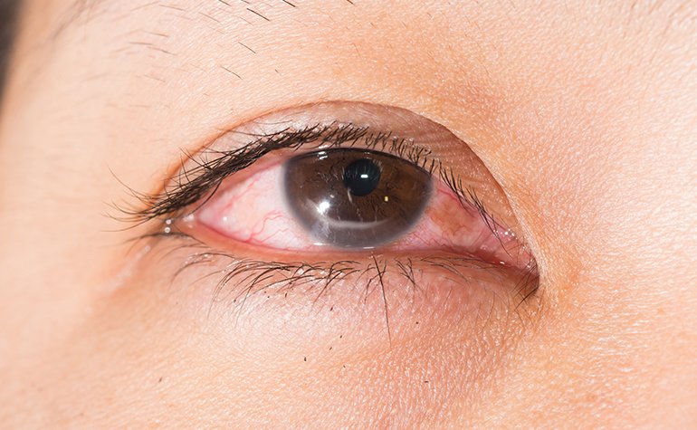 Hornhautentzündung: Symptome und Ursachen | Brille24 DE