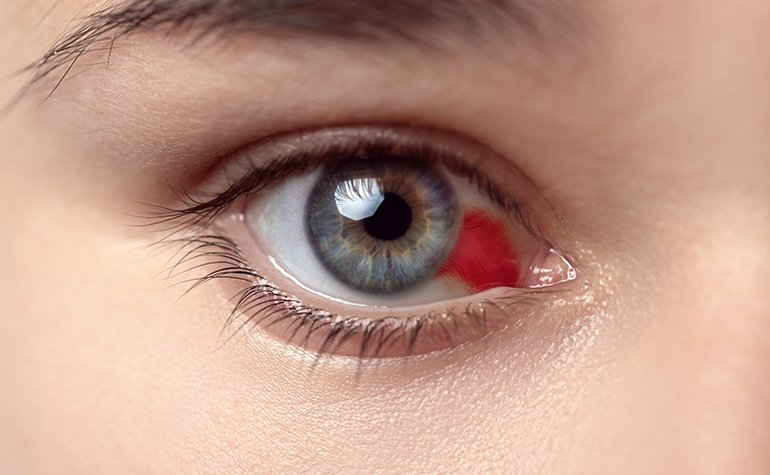 Subkonjunktivale Blutung: Ist sie gefährlich? | Brille24 DE